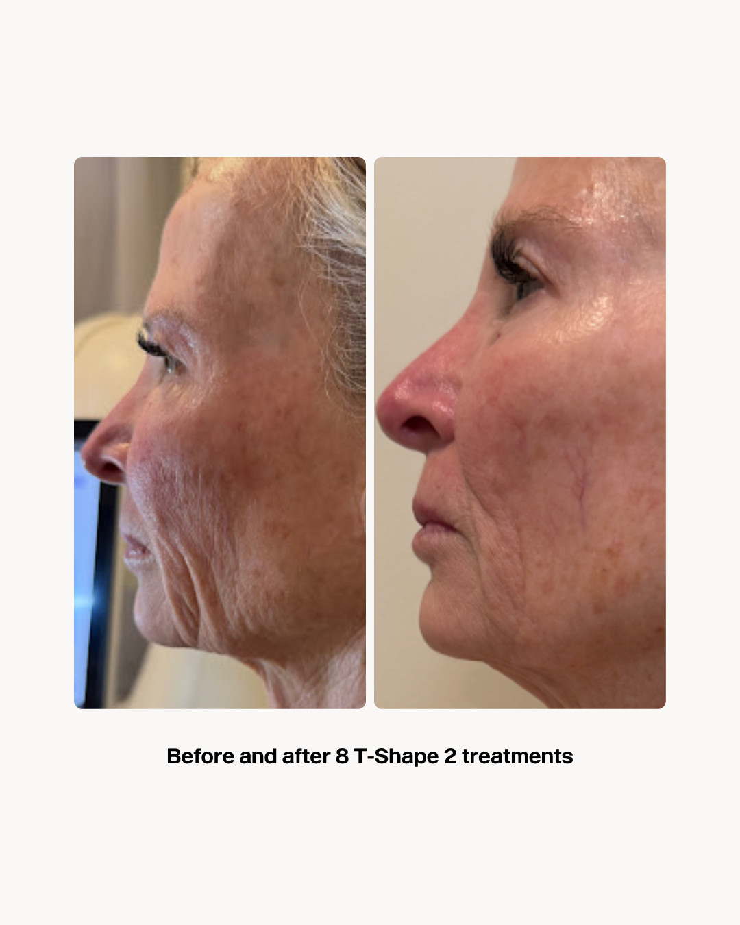 Skin Tightening Treatments: Achieve Smoother, Firmer Skin with T-Shape ...